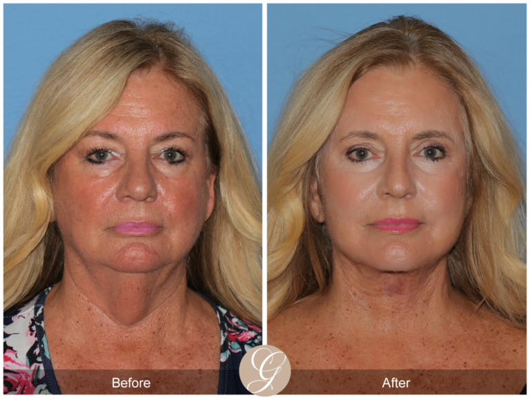 The Difference Between Deep Plane Facelift and SMAS Facelift