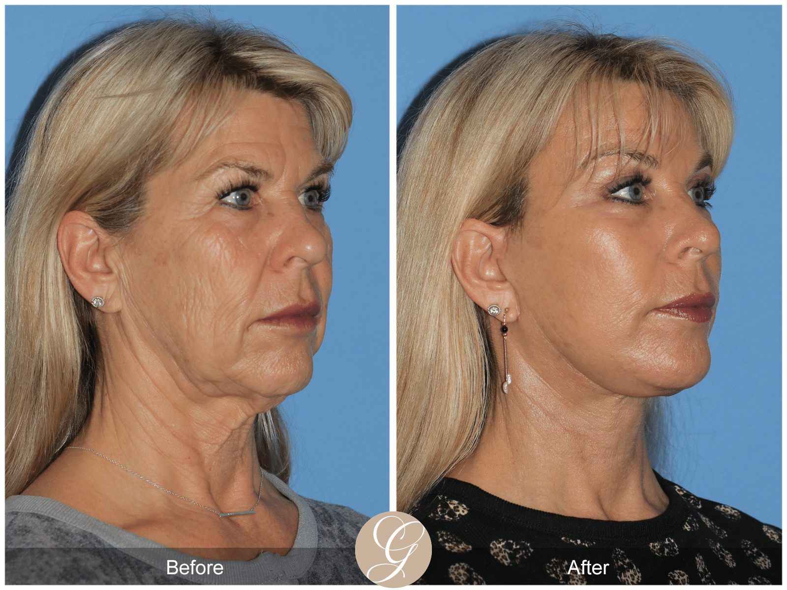 Deep Plane Facelift Case 12 Before After Photos Orange County