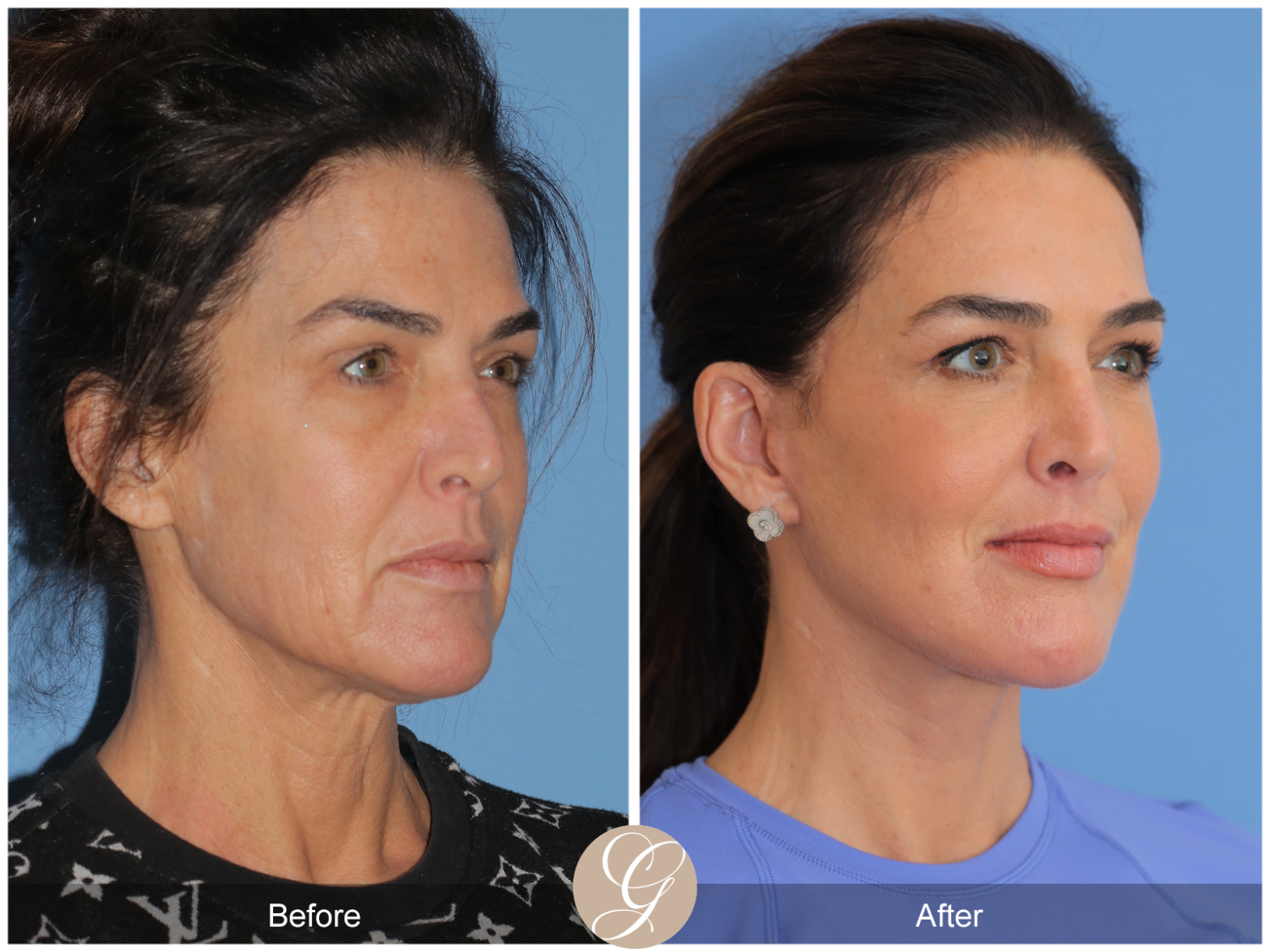 The Difference Between Deep Plane Facelift and SMAS Facelift | Sadati, MD